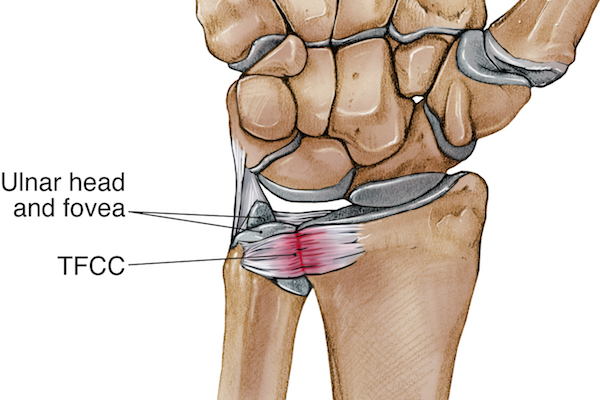 Triangular fibrocartilage complex injury